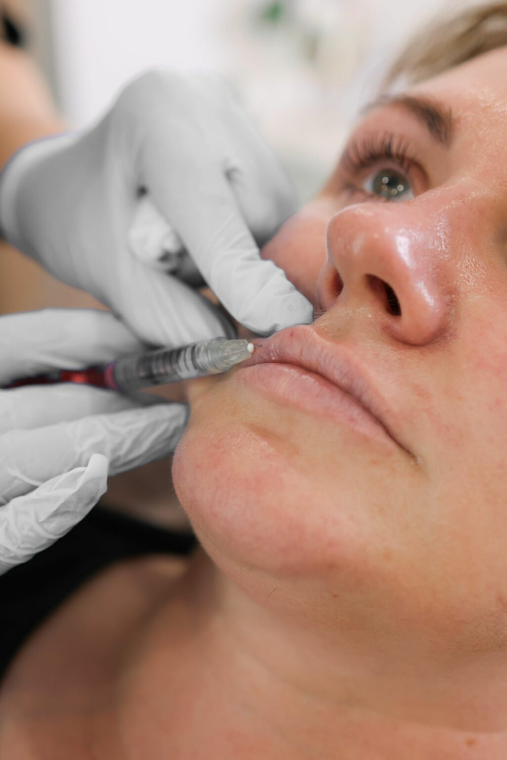 How to Find the Right Lip Filler Practitioner Near You - THP Shop